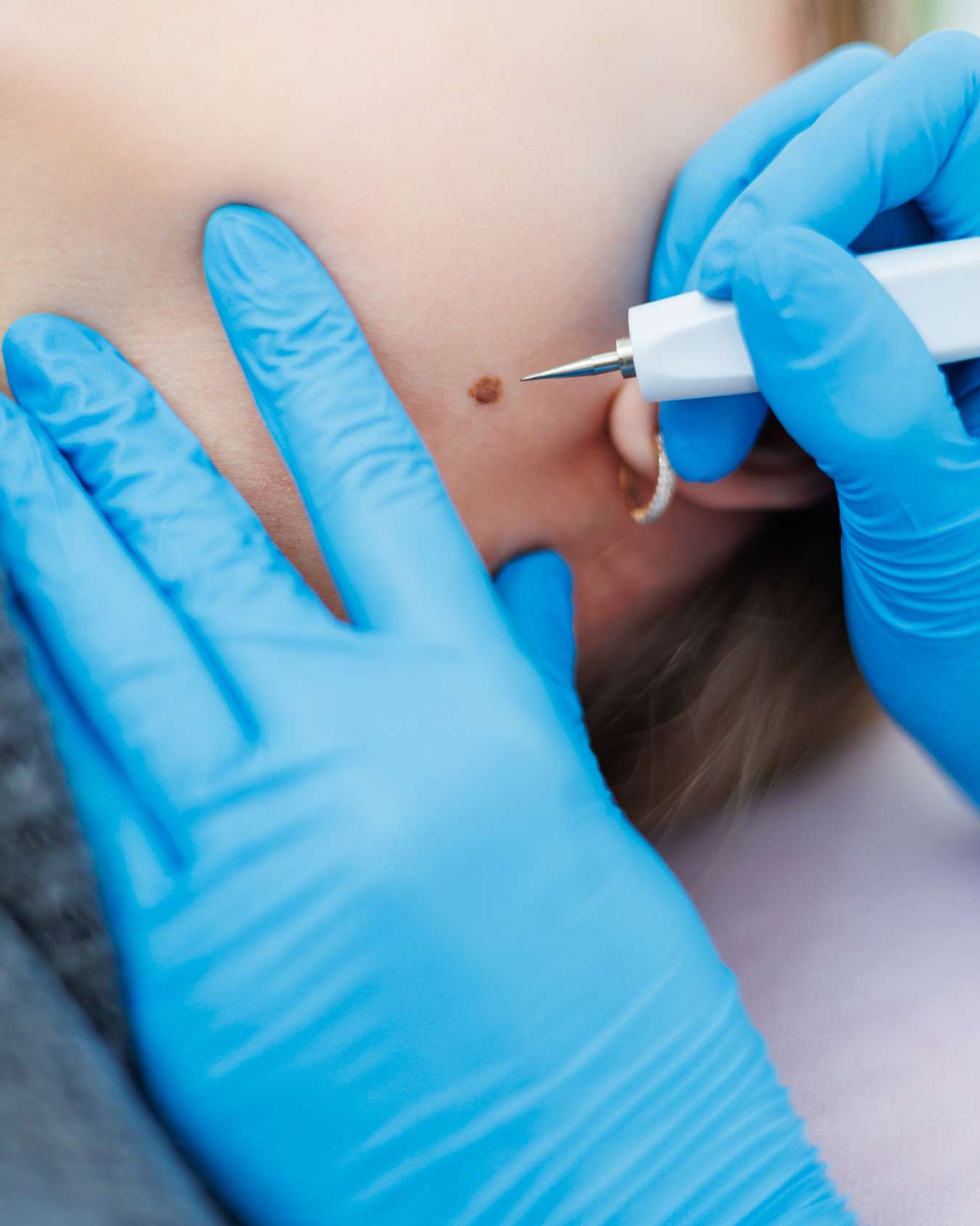 Curettage and Cautery - Skin Cancer Centre